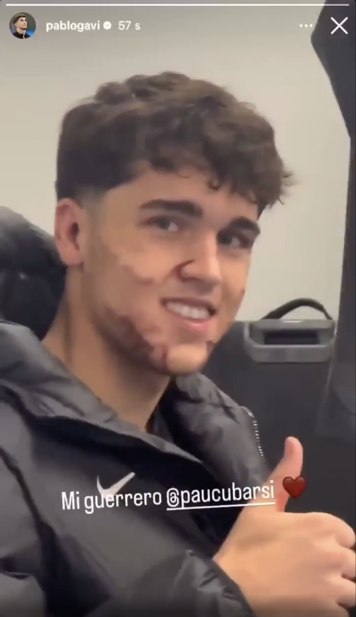 Barça’s Cubarsi reveals brutal battle scars after epic UCL clash